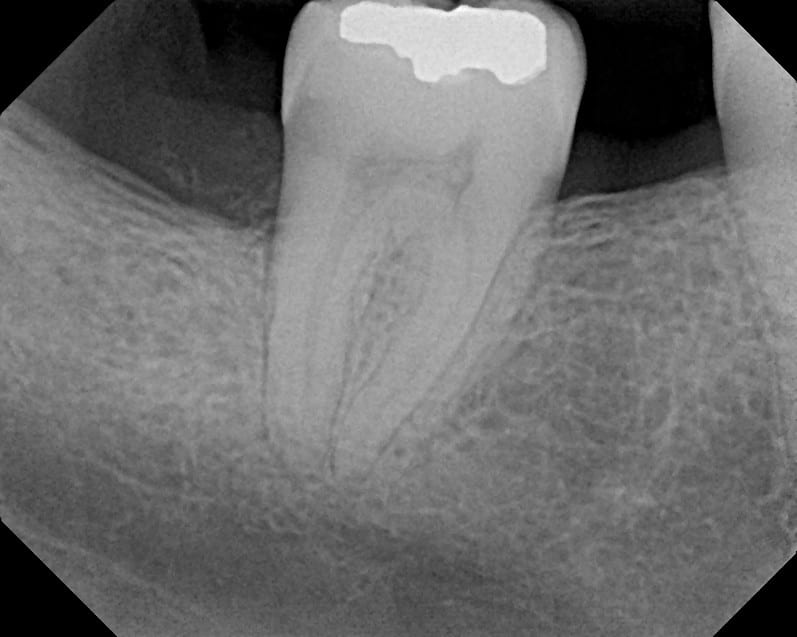 Regenerative Procedures | Tampa, FL | Tampa Bay Periodontics - Tampa ...