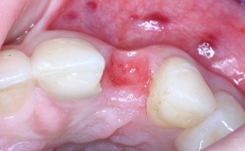 Ridge Augmentation Bone Grafting | Tampa, FL | Tampa Bay Periodontics ...