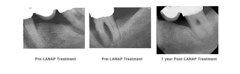 Laser Periodontal Therapy (LANAP) | Tampa, FL | Tampa Bay Periodontics ...