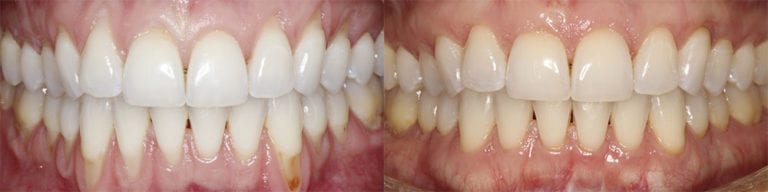 Connective Tissue Grafting For Root Coverage Tampa Fl Tampa Bay