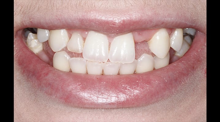 Tampa Bay Periodontics and Implant Dentistry - Accelerated Orthodontics ...